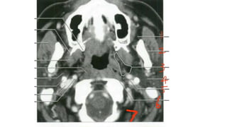 Deep neck spaces and muscles of neck- Radiology | PPTX