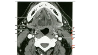 Deep neck spaces and muscles of neck- Radiology | PPTX