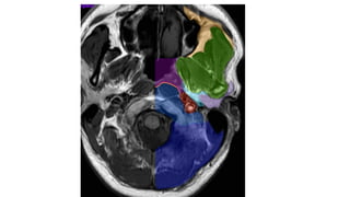 Deep neck spaces and muscles of neck- Radiology | PPTX