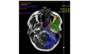 Deep neck spaces and muscles of neck- Radiology | PPTX