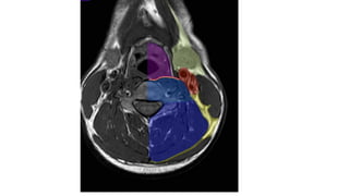 Deep neck spaces and muscles of neck- Radiology | PPTX