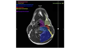 Deep neck spaces and muscles of neck- Radiology | PPTX