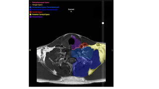 Deep neck spaces and muscles of neck- Radiology | PPTX
