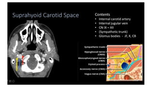 Deep neck spaces and muscles of neck- Radiology | PPTX