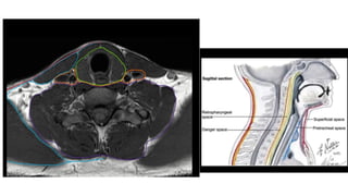 Deep neck spaces and muscles of neck- Radiology | PPTX