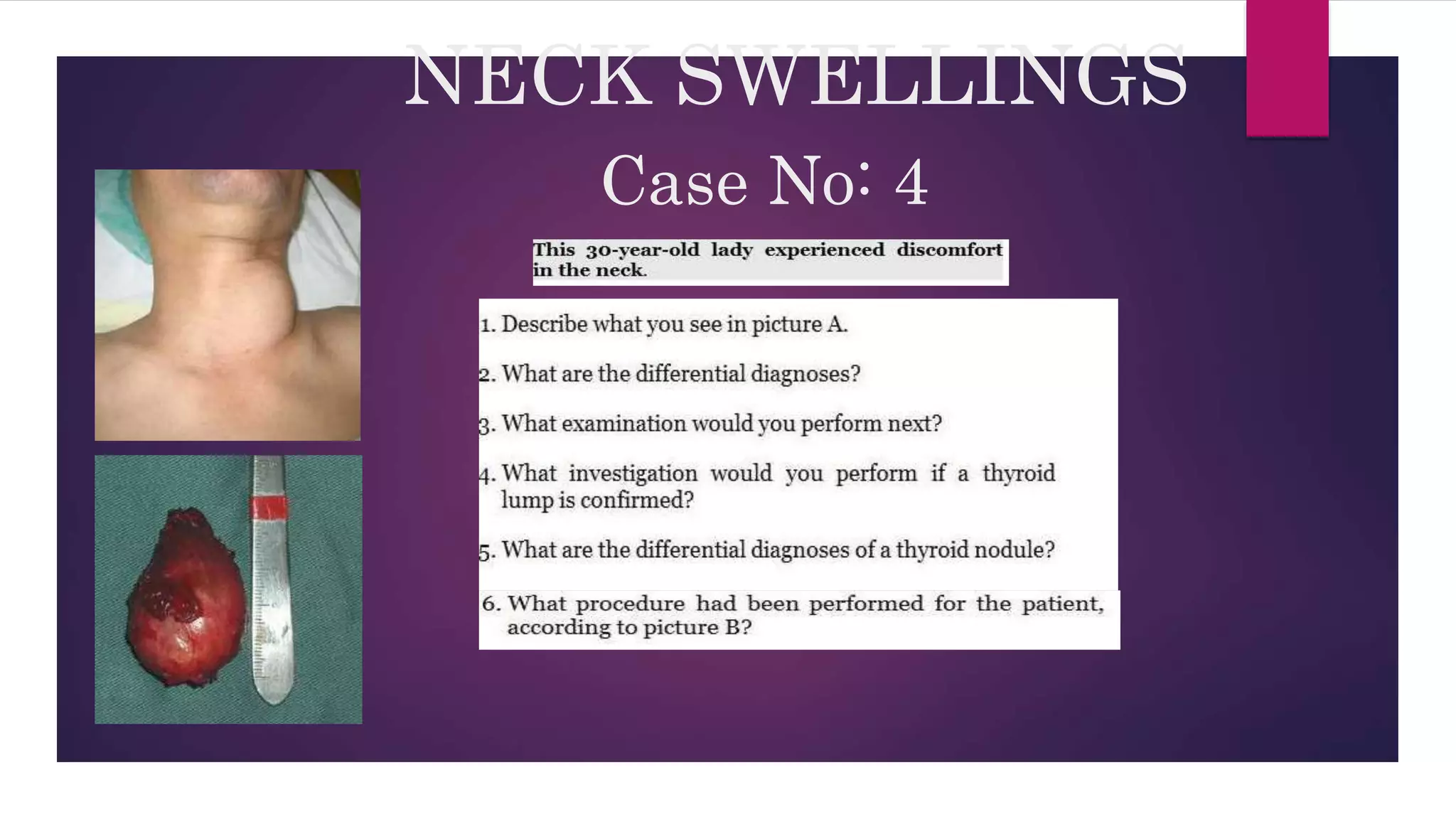 Goitre- Thyroid Swellings- Problem Based Learning/ Clinical case ...
