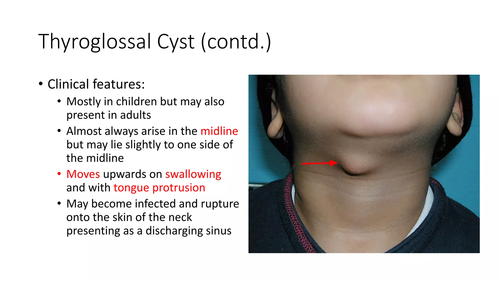 Neck swellings complete | PDF