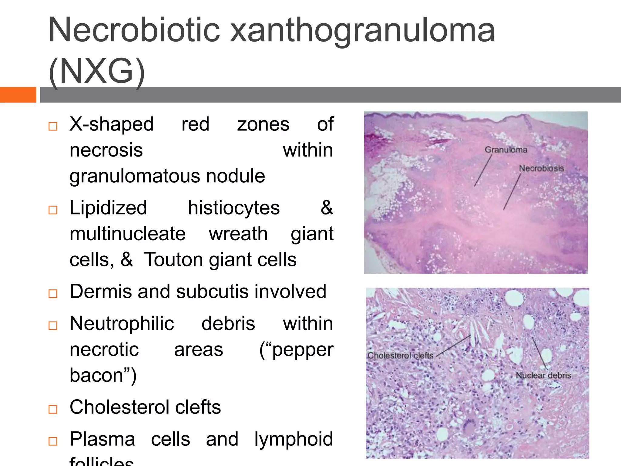 Necrobiosis lipoidica | PPTX