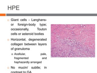 Necrobiosis lipoidica | PPTX