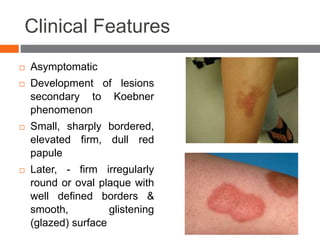 Necrobiosis lipoidica | PPTX
