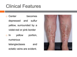 Necrobiosis lipoidica | PPTX