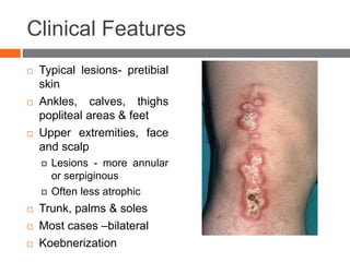 Necrobiosis lipoidica | PPTX