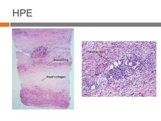 Necrobiosis Lipoidica Diabeticorum Histology
