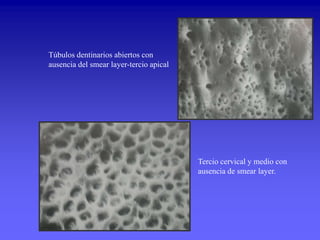 NECROPULPECTOMIA Y MEDICACIÃ N.ppt