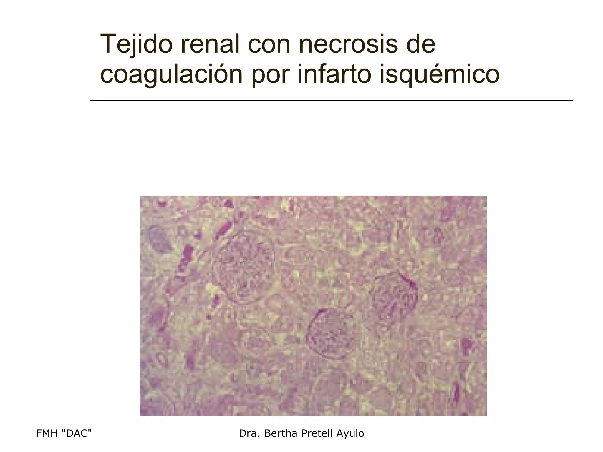 Necrosis | PPT