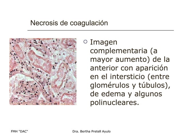 Necrosis | PPT