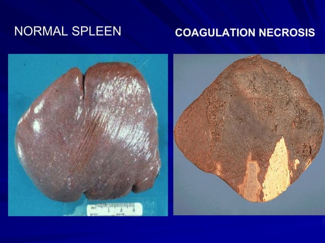 Necrosis | PDF | Diseases and Conditions | Medical Health