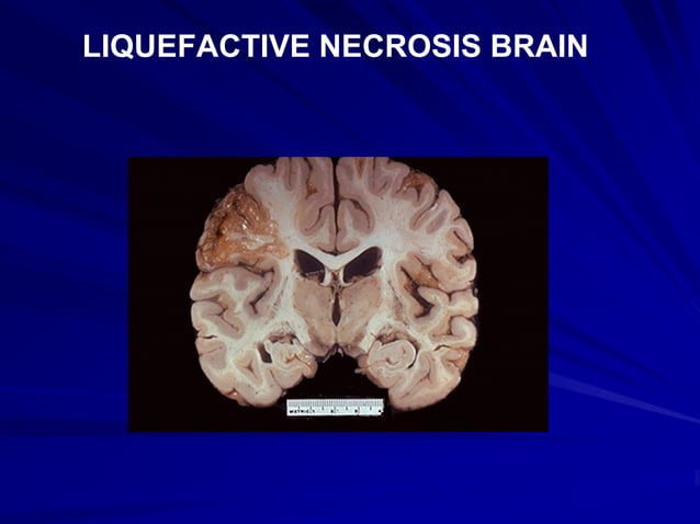 Necrosis | PDF | Diseases and Conditions | Medical Health
