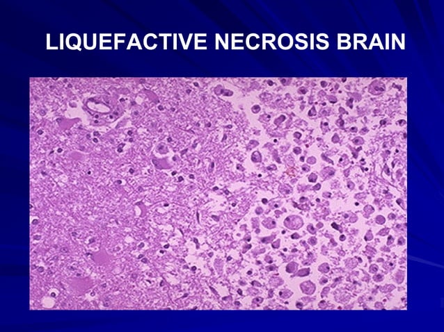 Necrosis | PDF | Diseases and Conditions | Medical Health