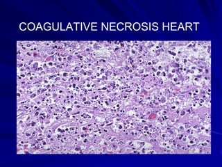 Coagulative Necrosis Heart