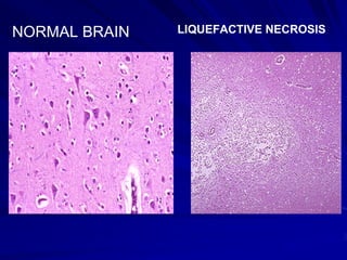 Caseous Necrosis Vs Liquefactive Necrosis