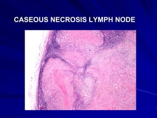 Caseous Necrosis Lymph Node