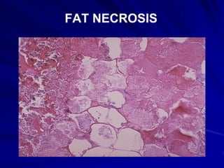 Necrotic Fat