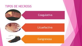 Necrosis | PPTX