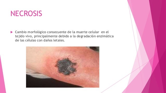 Necrosis
