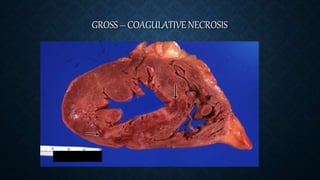 necrosis-160906190127.pptx
