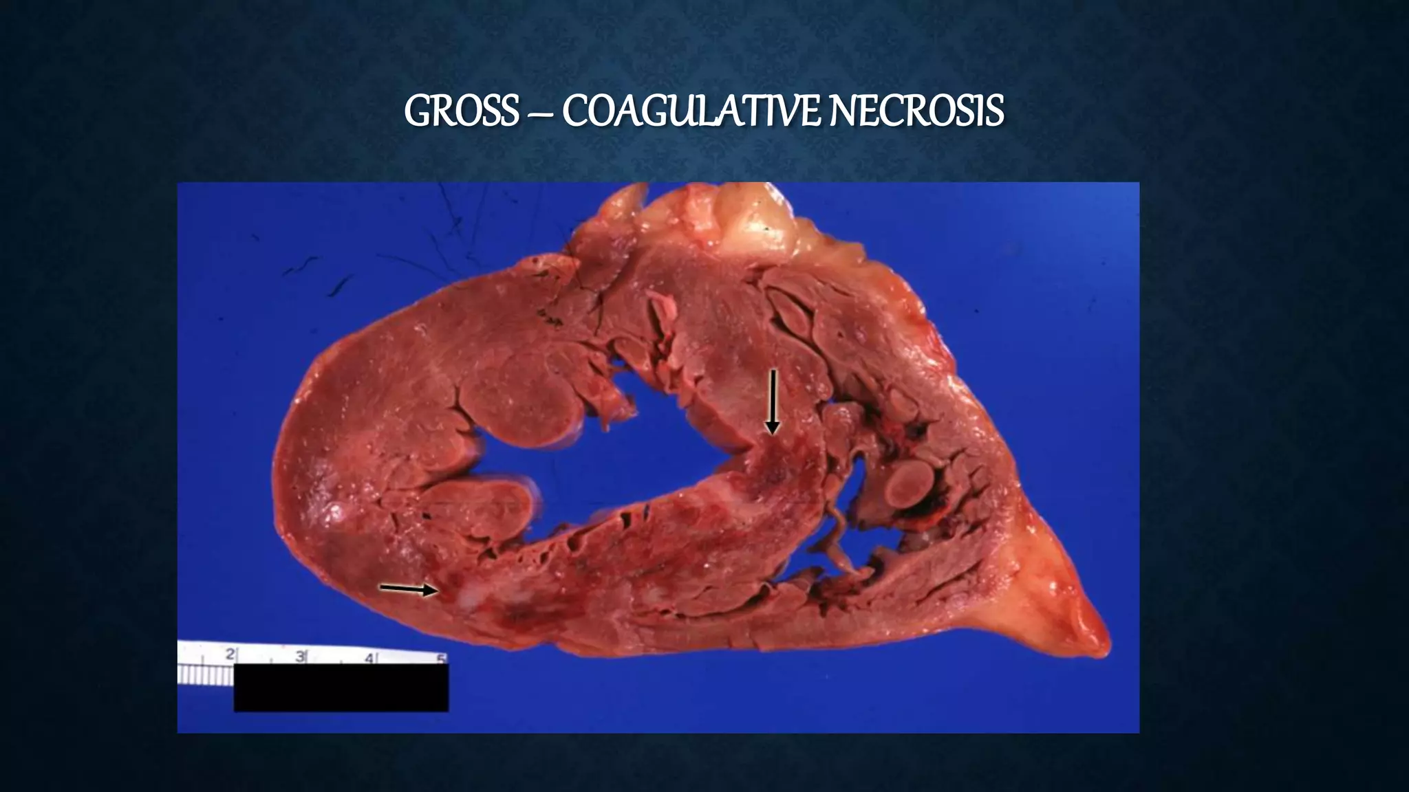 Necrosis | PPTX