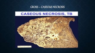 Caseous Necrosis Gross