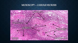 Caseous Necrosis Lymph Node