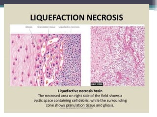 Necrosis | PPTX