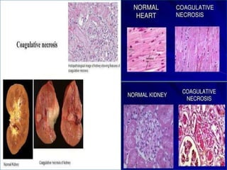 Necrosis and types | PPTX