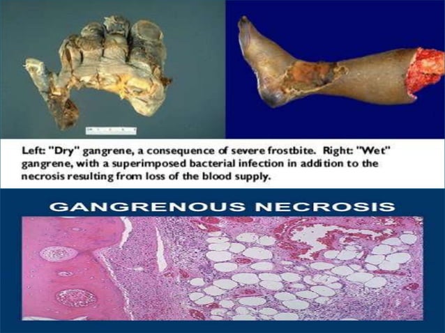 Necrosis and types | PPTX | Blood Disorders | Diseases and Conditions
