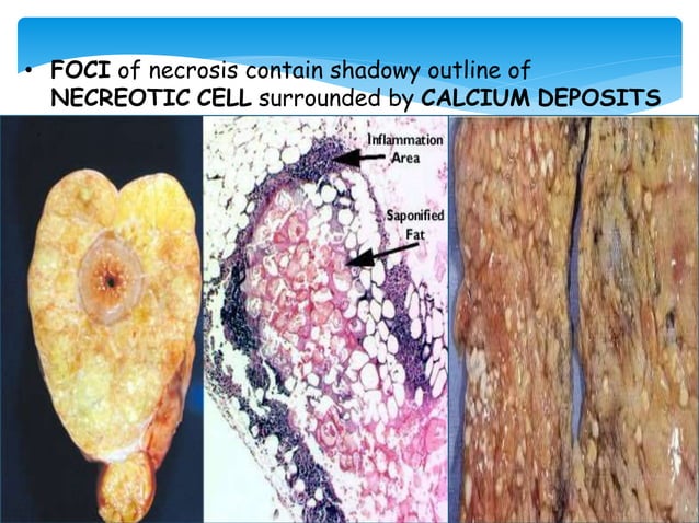 Necrosis and types | PPTX | Blood Disorders | Diseases and Conditions