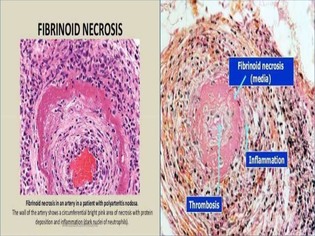 Necrosis and types | PPTX | Blood Disorders | Diseases and Conditions