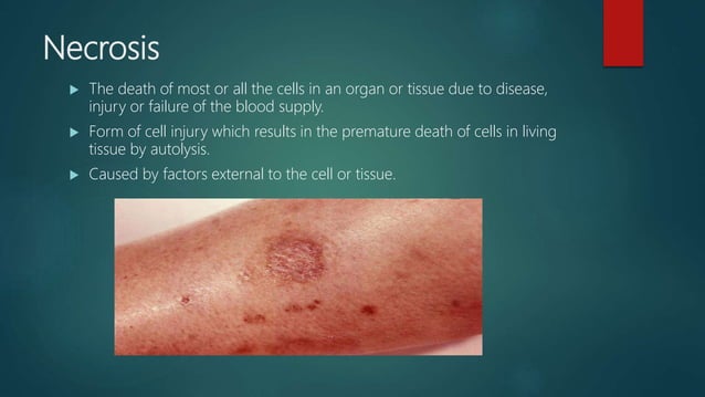 Necrosis | PPT