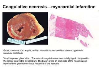 Coagulative Necrosis Gross