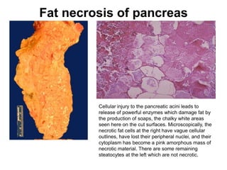Fat Necrosis Pancreas