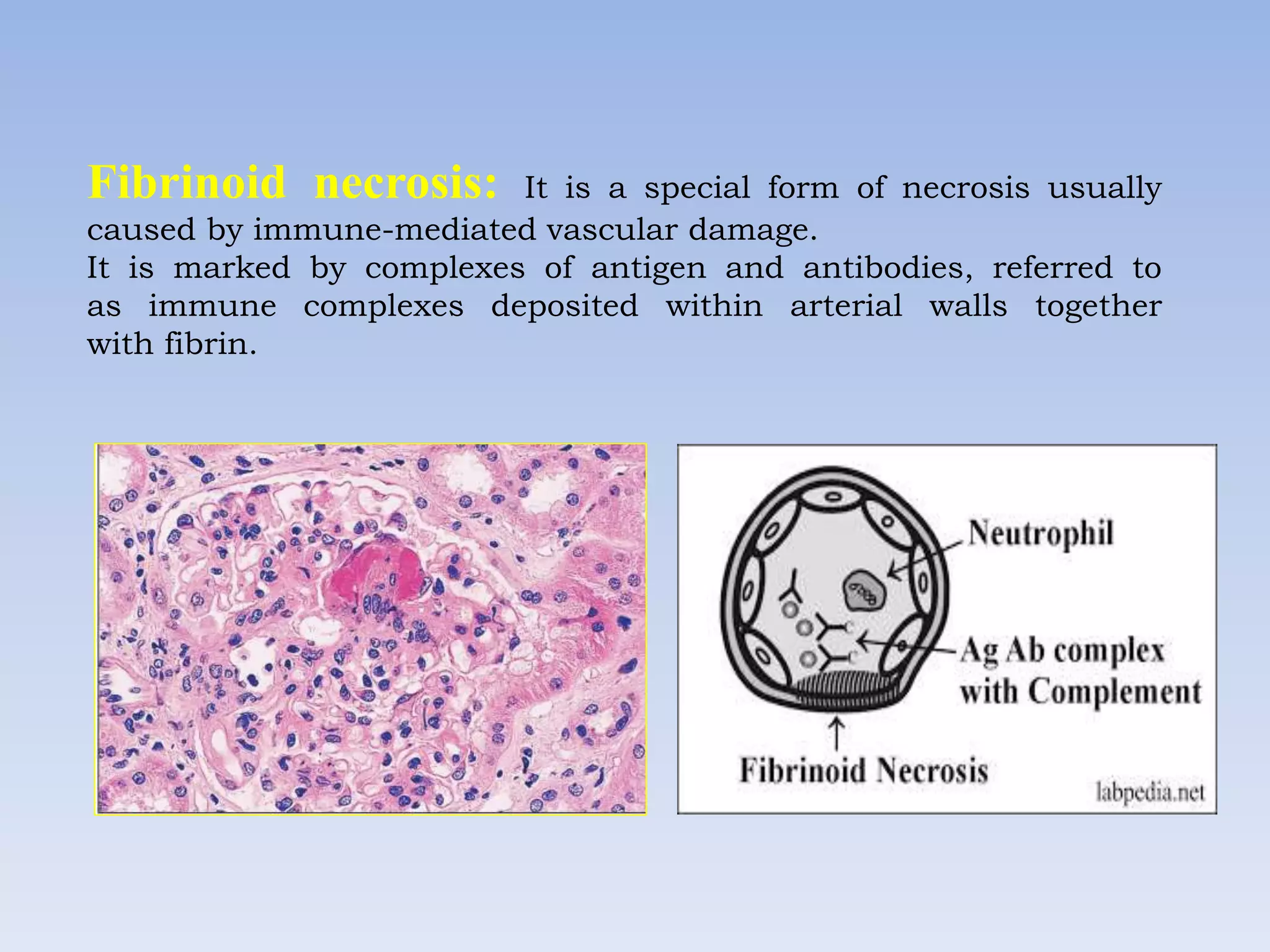 Necrosis | PPTX