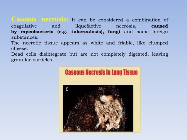 Necrosis | PPTX | Blood Disorders | Diseases and Conditions