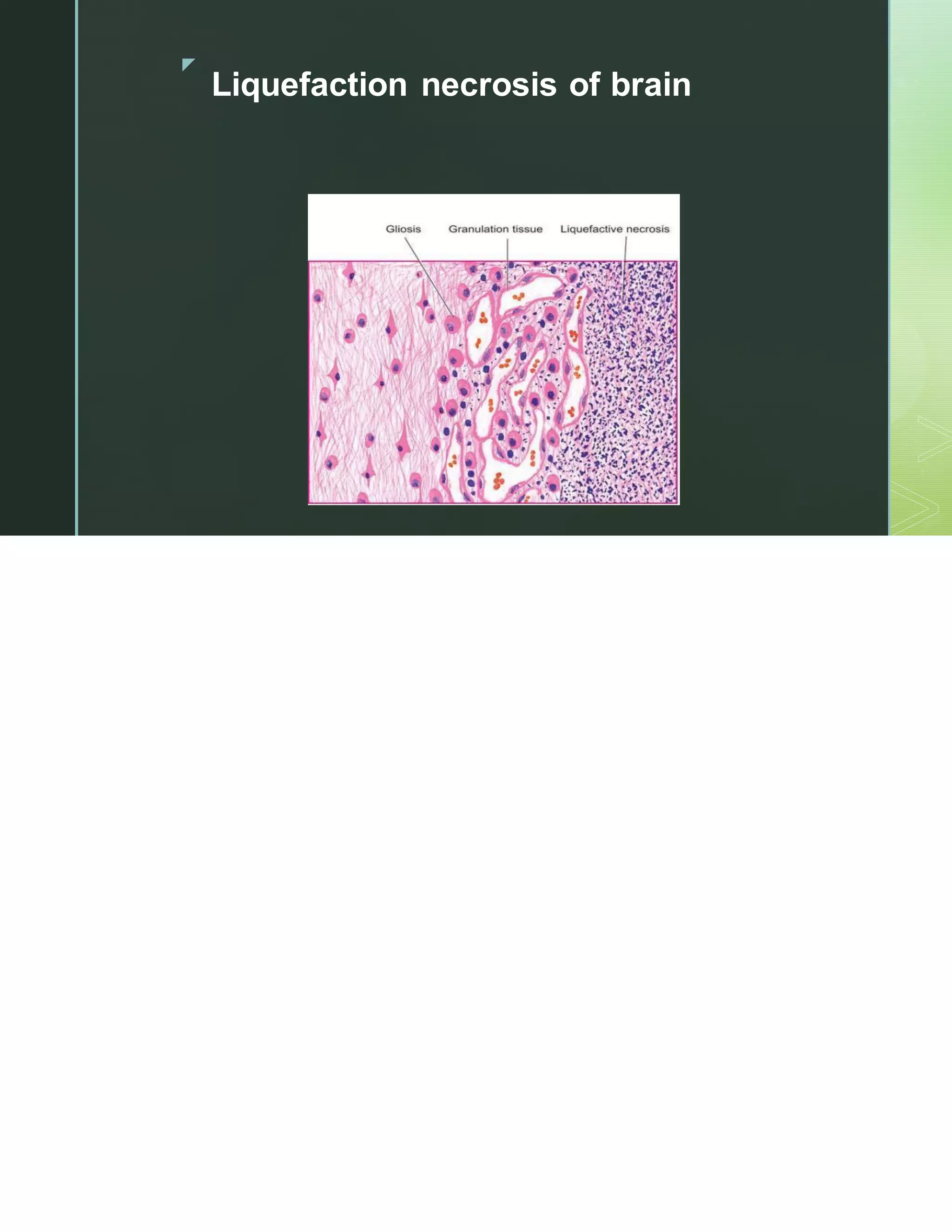 Necrosis | PDF