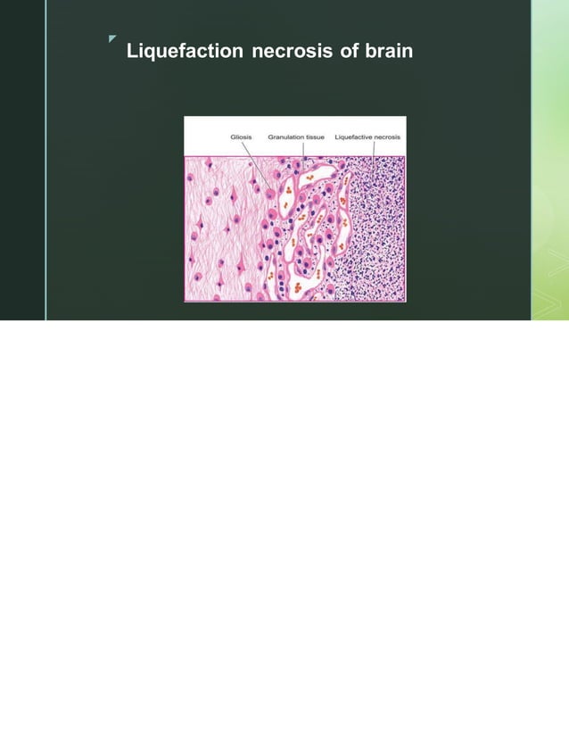Necrosis | PDF