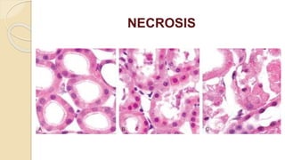 necrosis.pptx