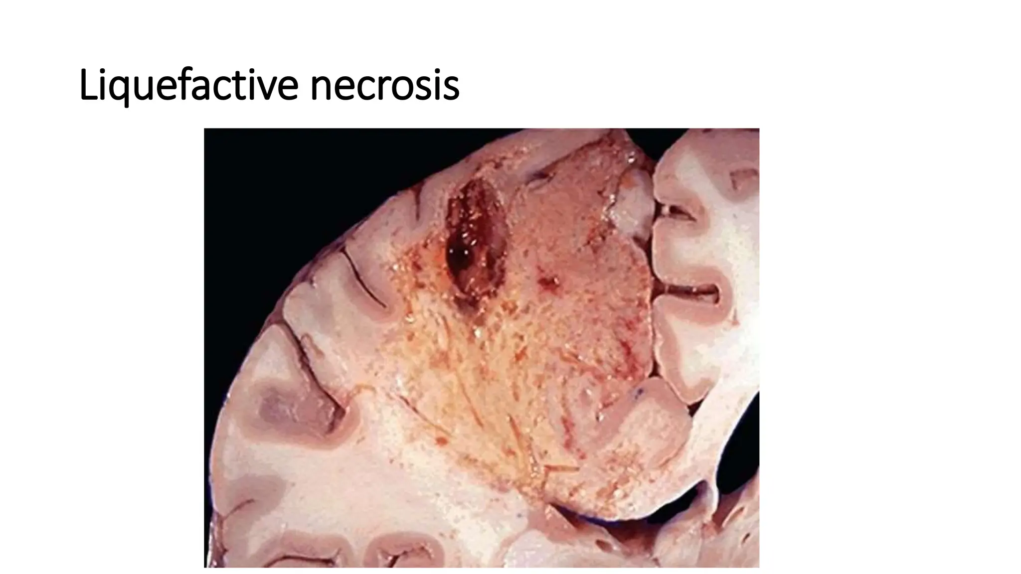 Necrosis.pptx definition, types, examples | PPTX
