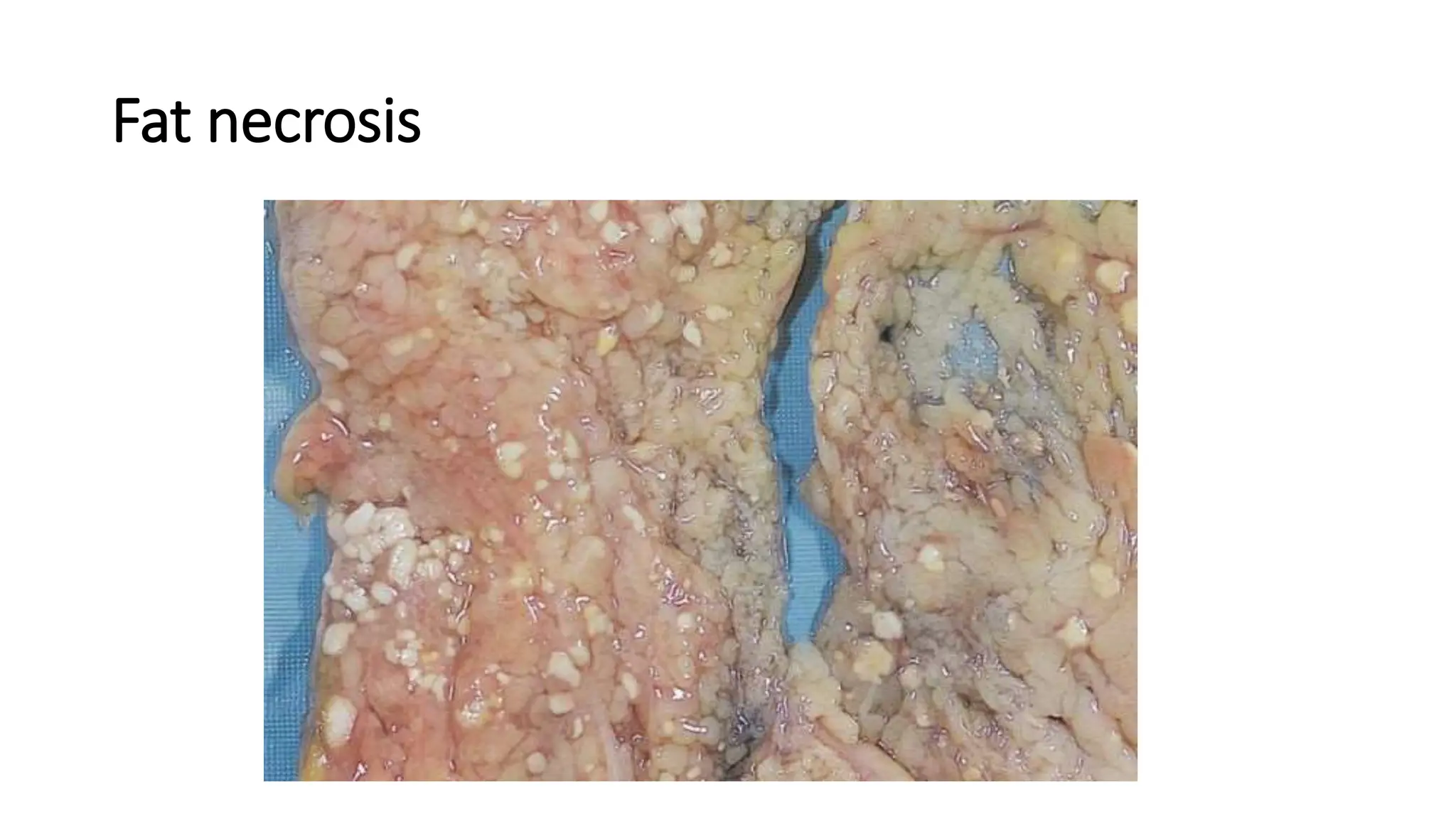 Necrosis.pptx definition, types, examples | PPTX