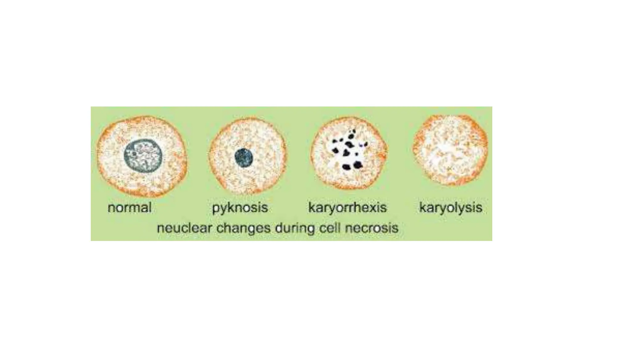 Necrosis.pptx definition, types, examples | PPTX