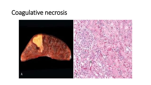 Necrosis.pptx definition, types, examples | PPTX | Blood Disorders ...